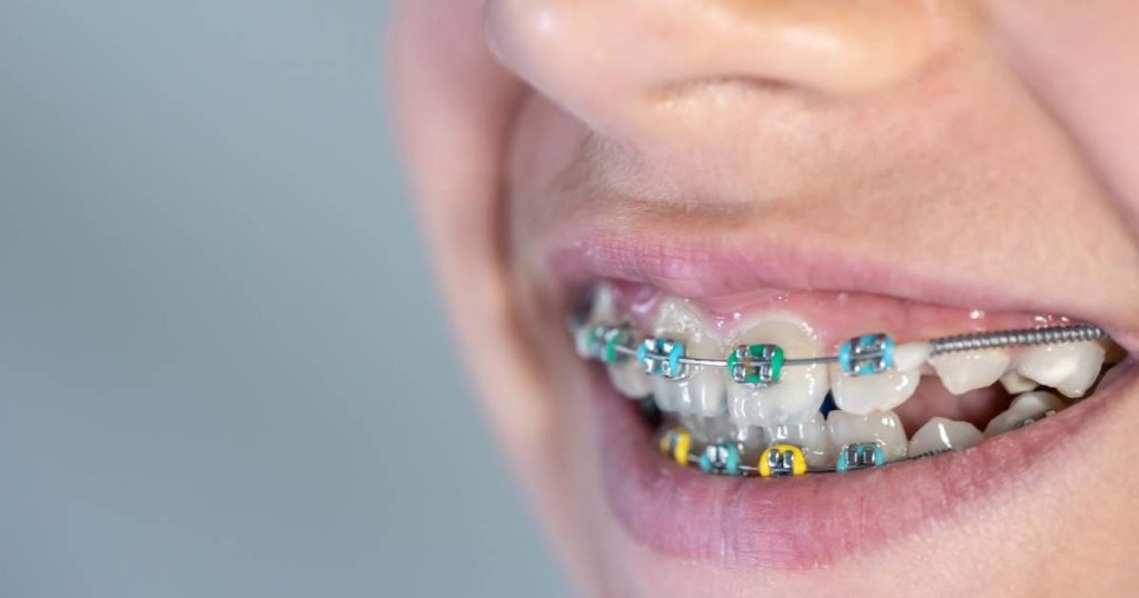 Braces Colors Guide | Find Your Perfect Shade