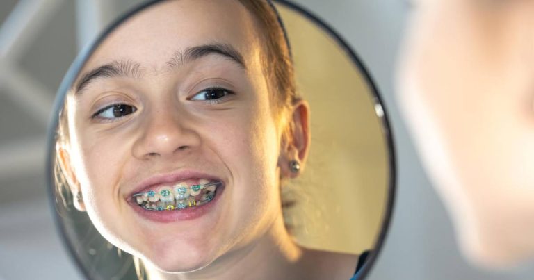 Braces Colors Guide | Find Your Perfect Shade
