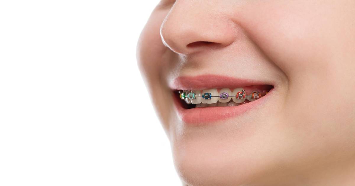 Braces Colors Guide | Find Your Perfect Shade