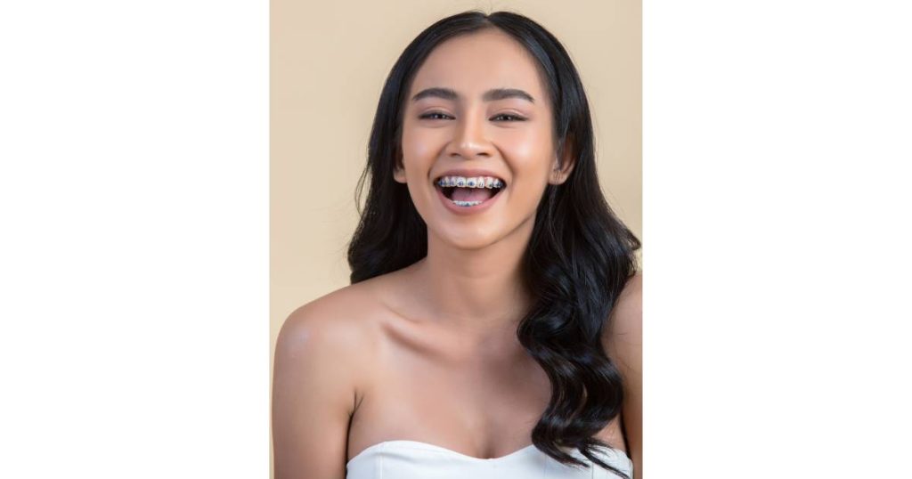 Braces Colors Guide | Find Your Perfect Shade